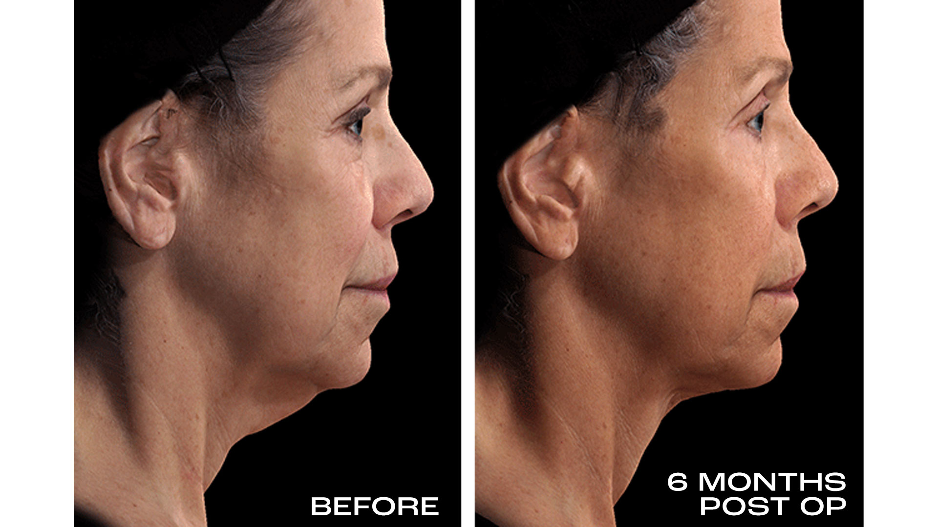 RENUVION - FDA-Cleared 1-Hour Neck Procedure